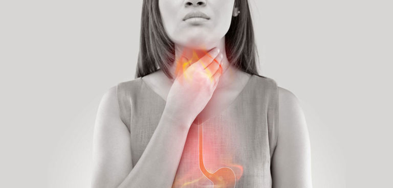 ICD-10 Codes for GERD and Symptoms of GERD - DocCharge